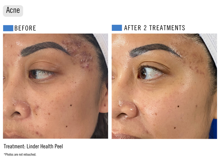 Chemical Peels – Linder Health