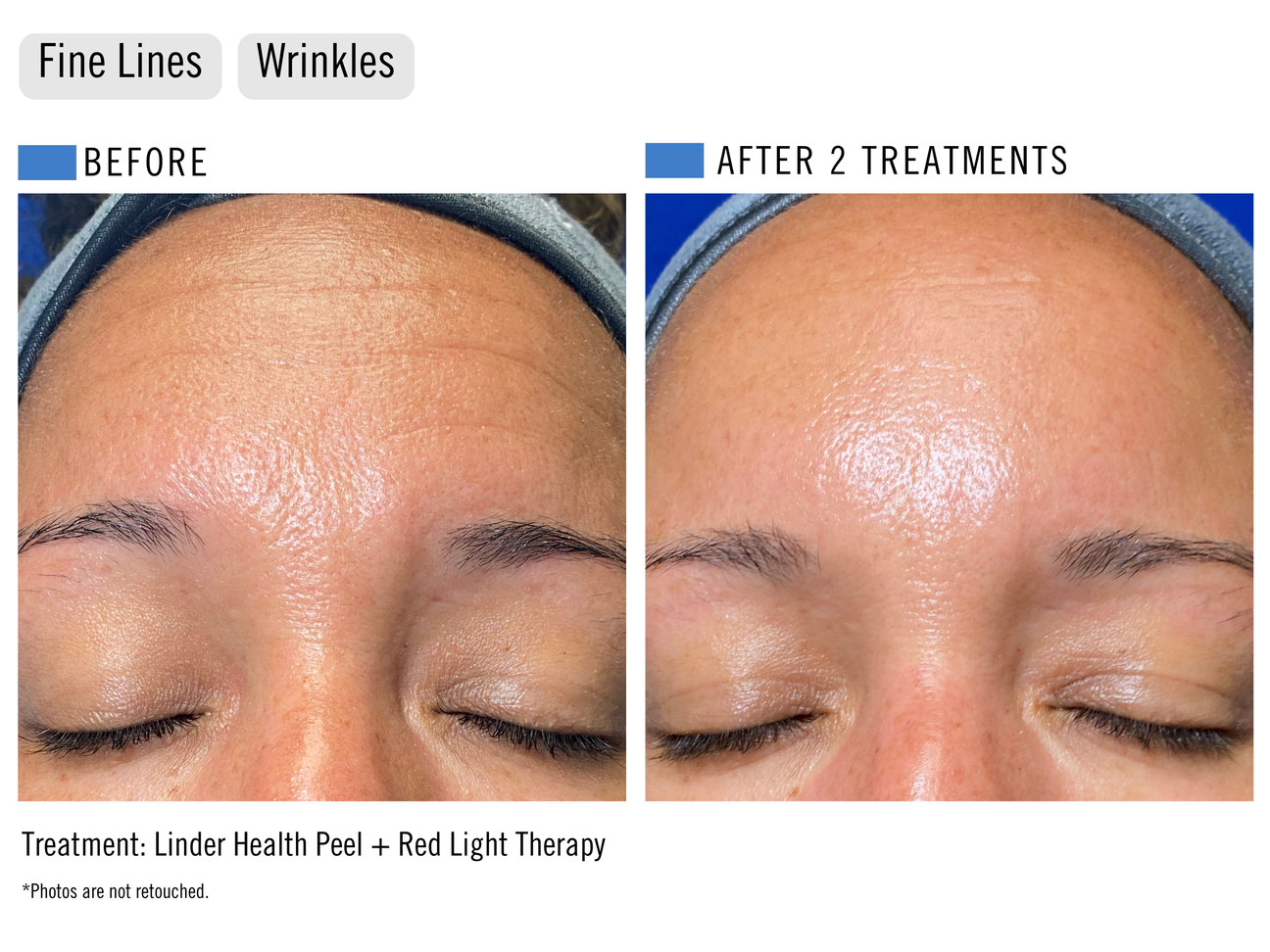 Chemical Peels – Linder Health